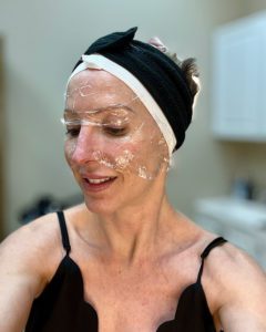 An honest Plasma Pen fibroblast skin tightening review | Before, during ...