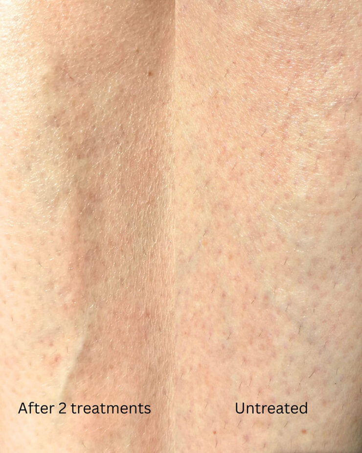 Tria 4X Review: 90-Day At-Home Laser Hair Removal Results