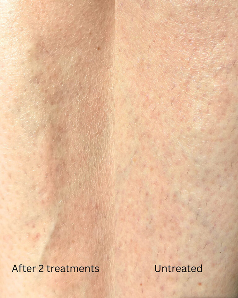 Tria 4X Review: 90-Day At-Home Laser Hair Removal Results
