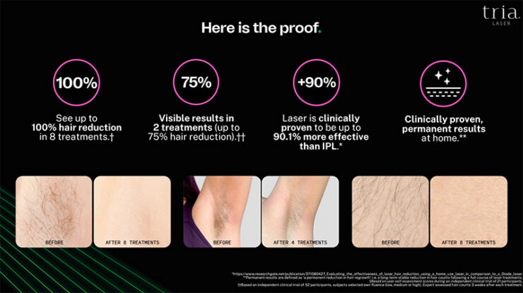 Tria 4X Review: 90-Day At-Home Laser Hair Removal Results
